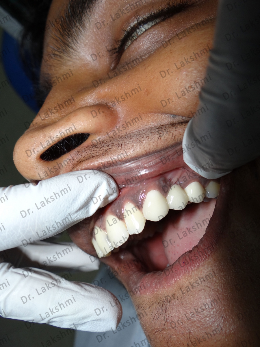 Tooth Replacement in Bangalore | Tooth implants in Bangalore